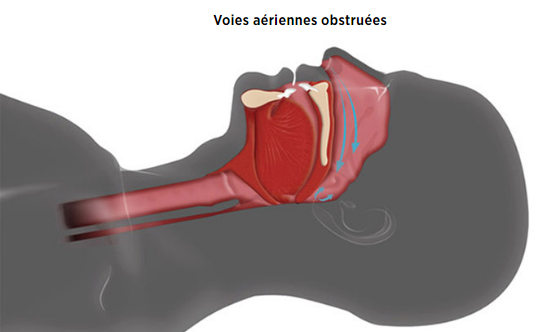 Apnée Du Sommeil | Fisher & Paykel Healthcare