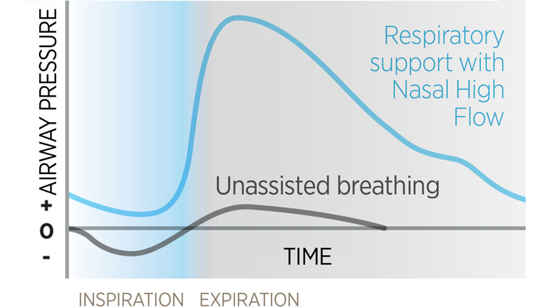 F&P Optiflow™ Mechanisms of Action | Fisher & Paykel Healthcare